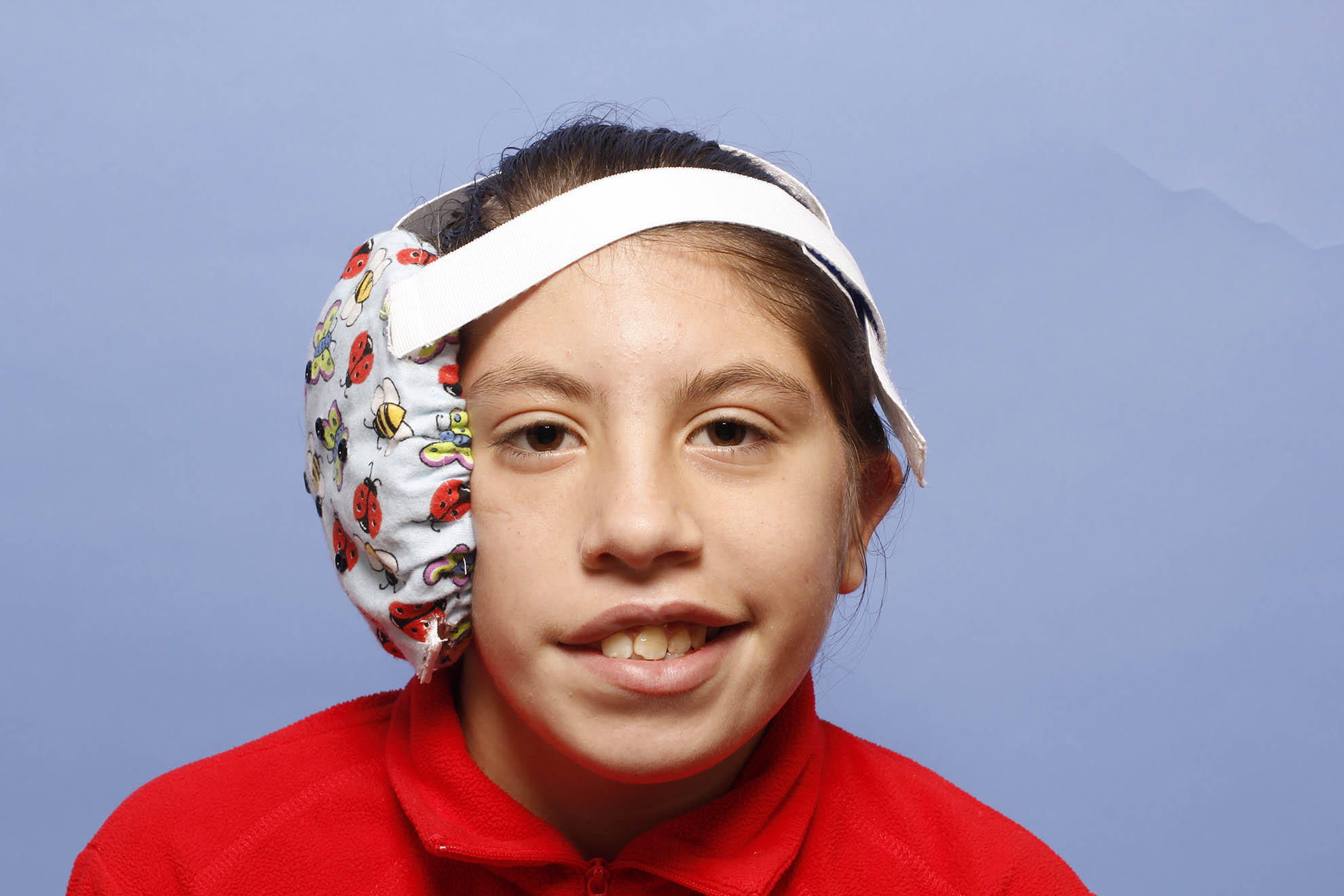 What is Goldenhar Syndrome? – Little Baby Face