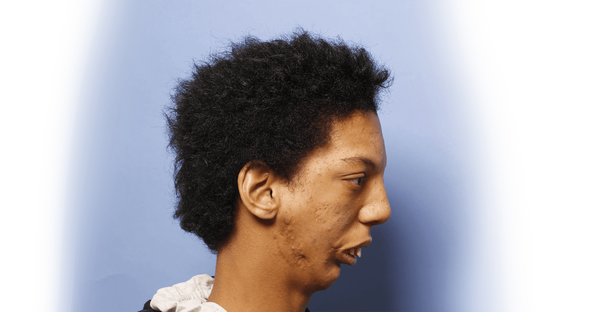 What Is Pierre Robin Syndrome – Little Baby Face